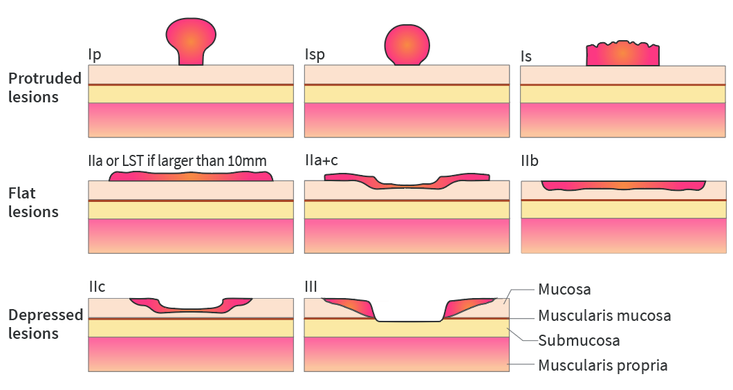 Mistakes in the management of gastric polyps and how to avoid them | UEG - United European ...