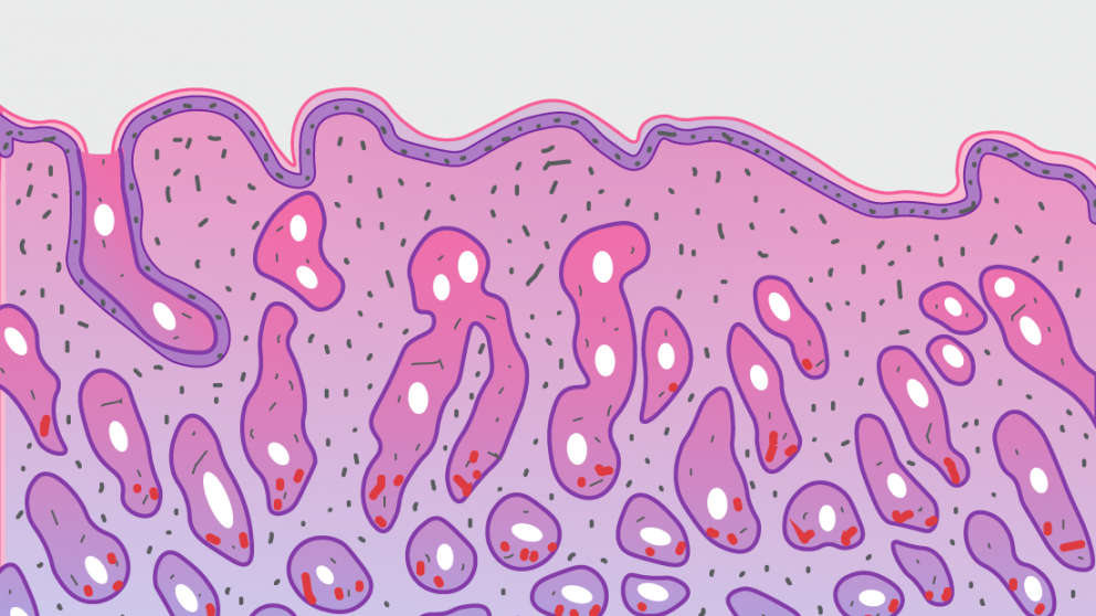 Management of early-invasive (T1) colorectal cancer | UEG - United ...