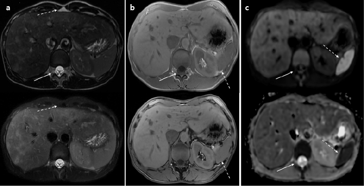Mistakes in imaging hepatic lesions and how to avoid them | UEG ...