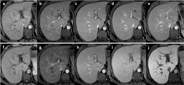 Mistakes in imaging hepatic lesions and how to avoid them | UEG ...