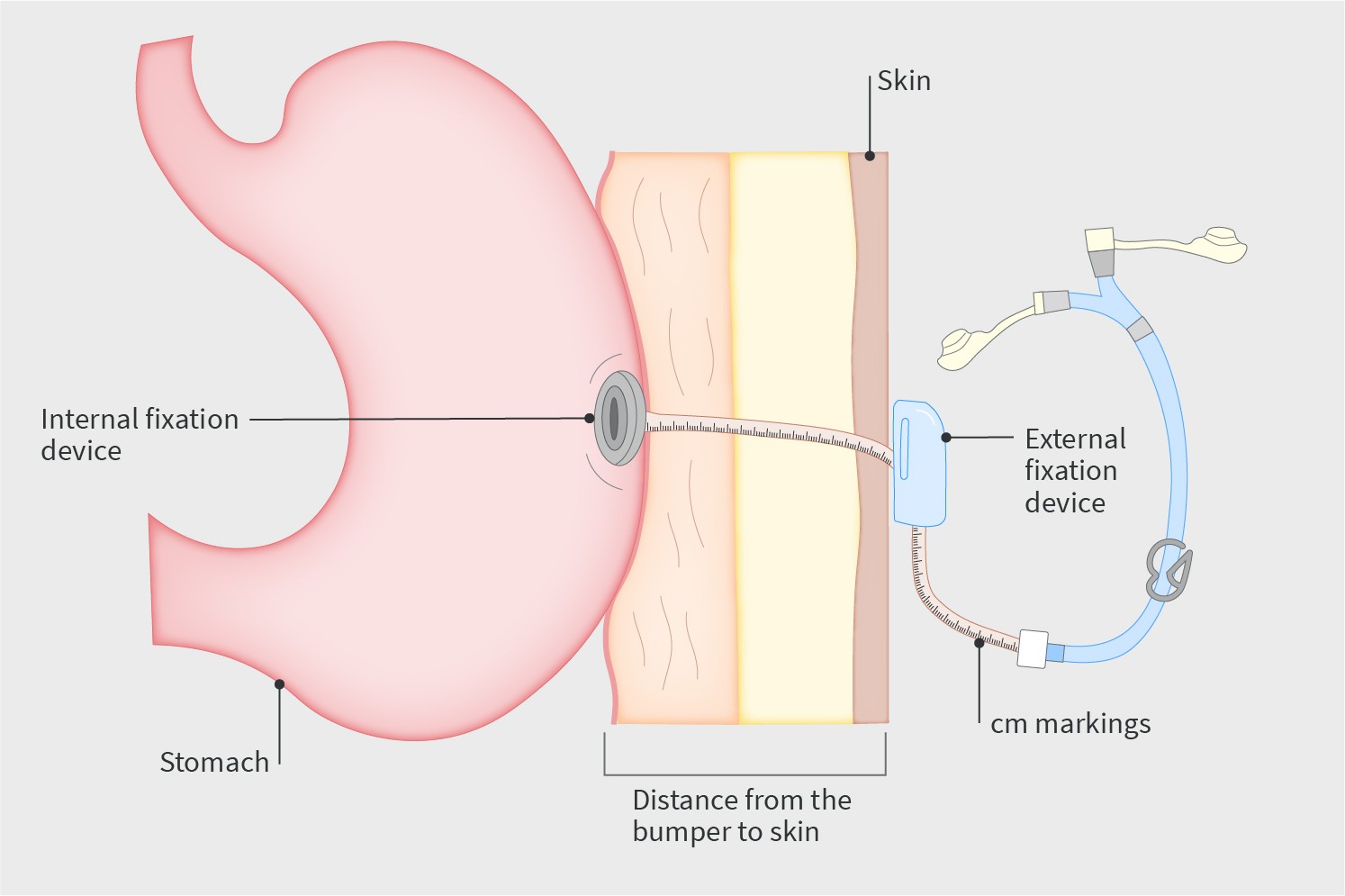 Mistakes in gastrostomy insertion and how to avoid them | UEG - United European Gastroenterology