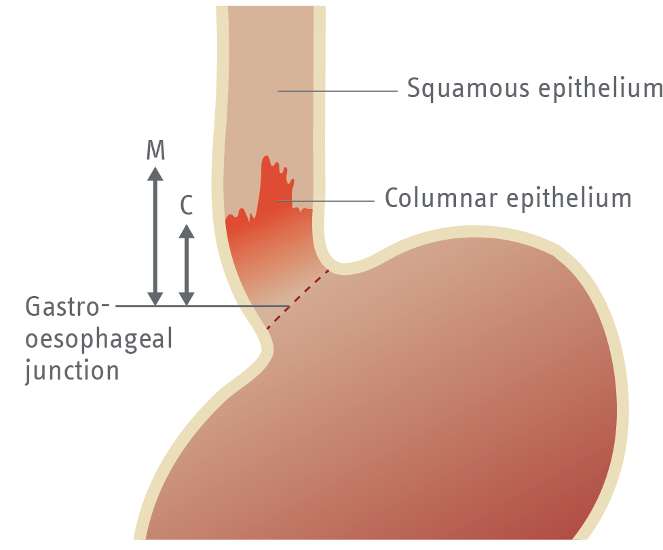 Mistakes in the endoscopic diagnosis and management of Barrett’s ...