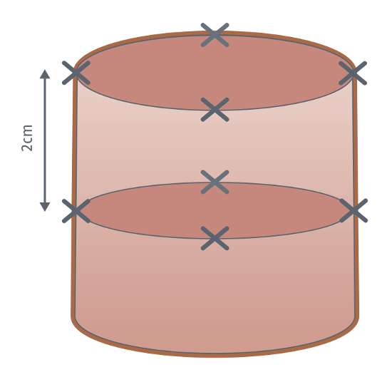 Mistakes in the endoscopic diagnosis and management of Barrett’s ...